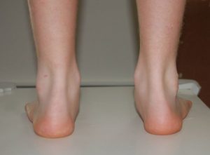 Blog - Ottawa Foot Clinic