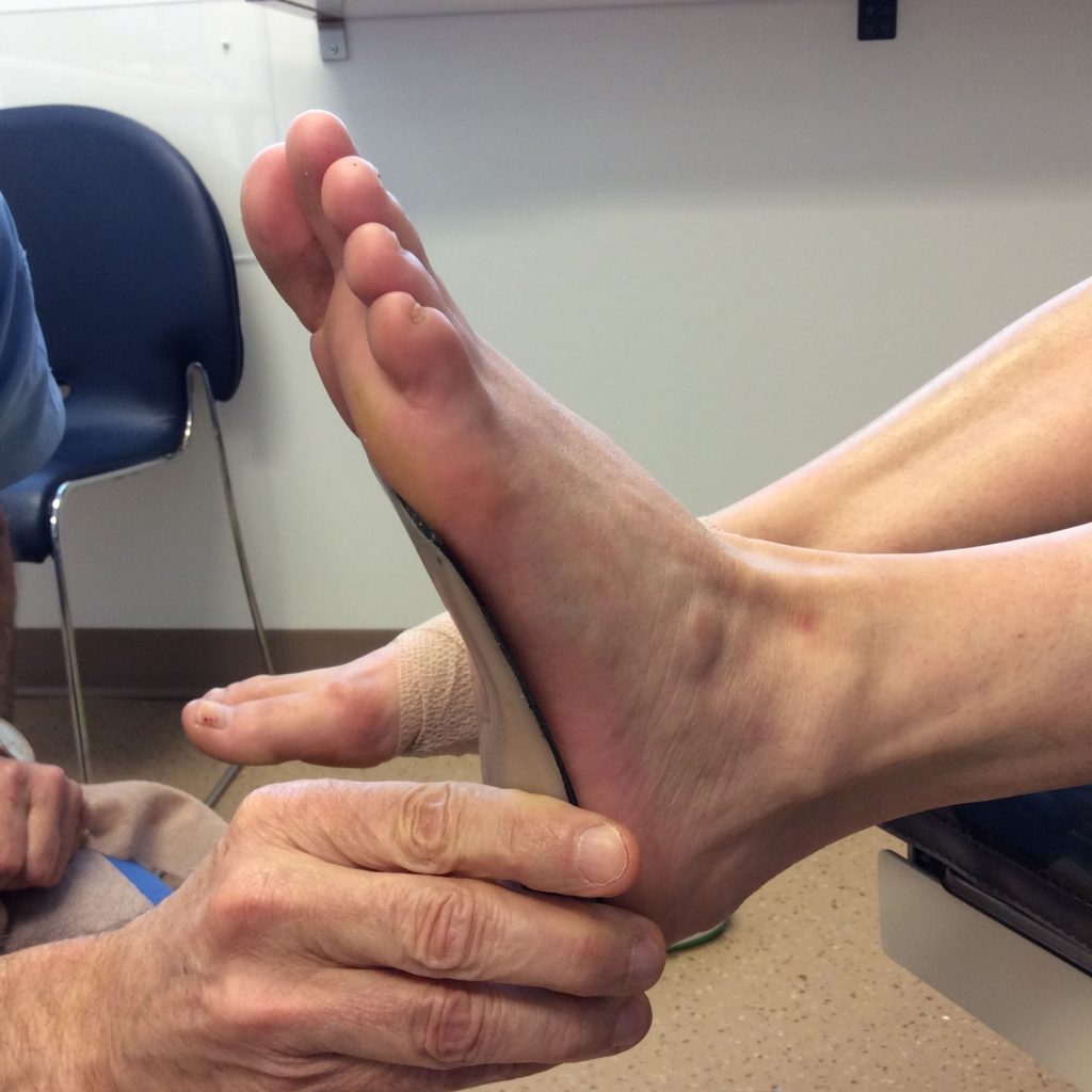 Custom-made Orthotics - Ottawa Foot Clinic