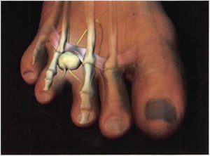Morton's Neuroma - Ottawa Foot Clinic